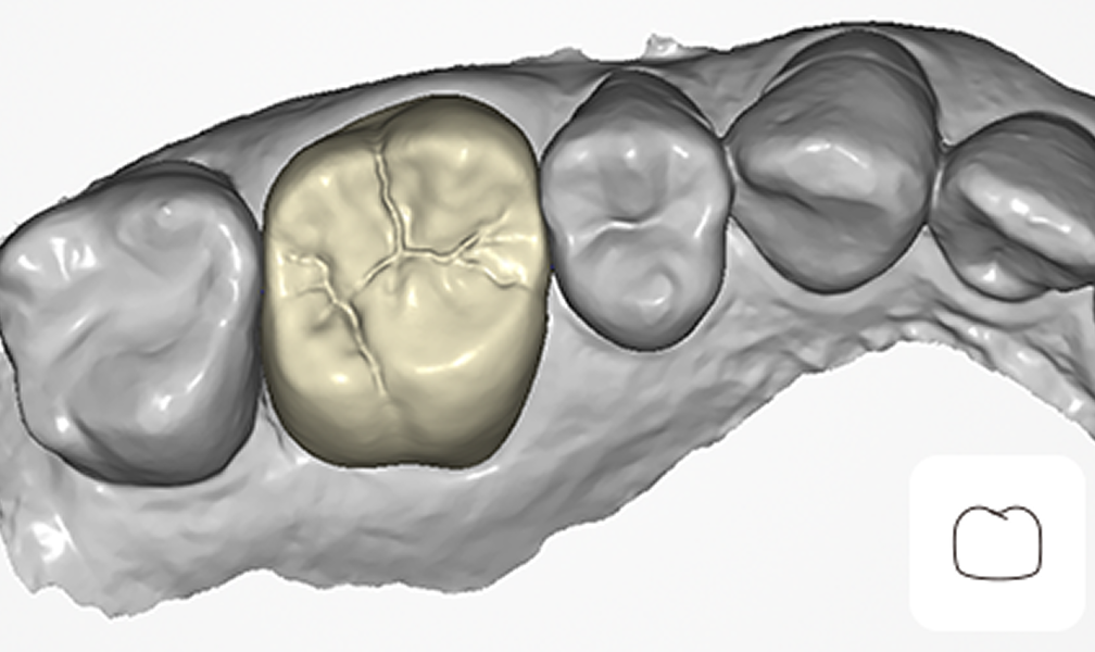 UPCAD – Smarter, Intuitive Dental CAD | UP3D